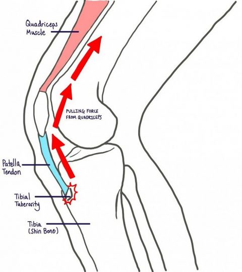 Knee pain in the growing child: Osgood-Schlatter Disease - PhysioX